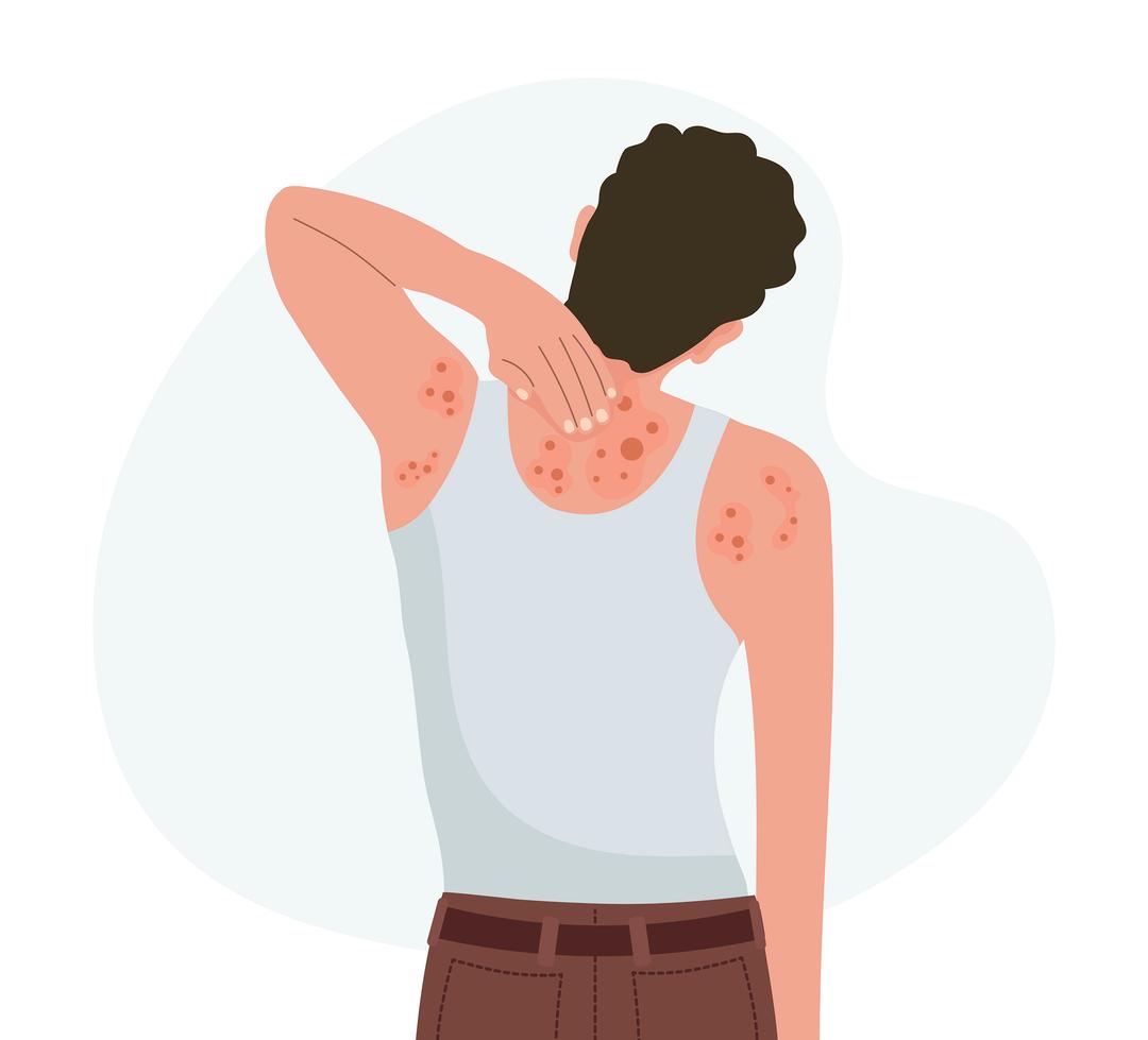 Sauna ja ihottuma | Hikoilu laukaisee ihottuman | Mistä on kyse? | Apu