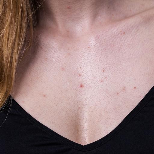 Rasvaluomi | Miten eroon? Apu-klinikka, Pippa Laukka vastaa | Apu