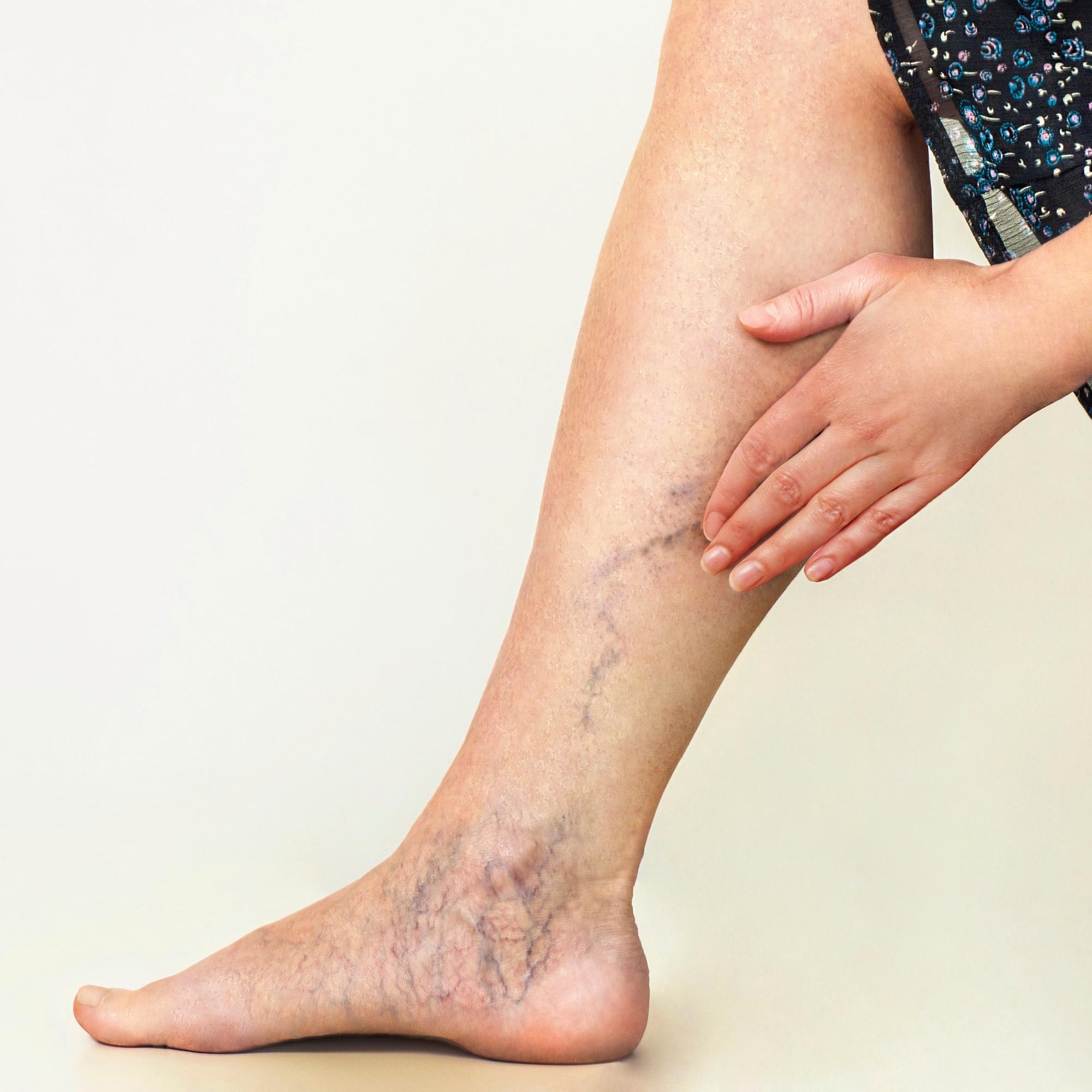 Veritulppa voi olla oireeton: 9 kysymystä + 3 vinkkiä ehkäisyyn | Apu