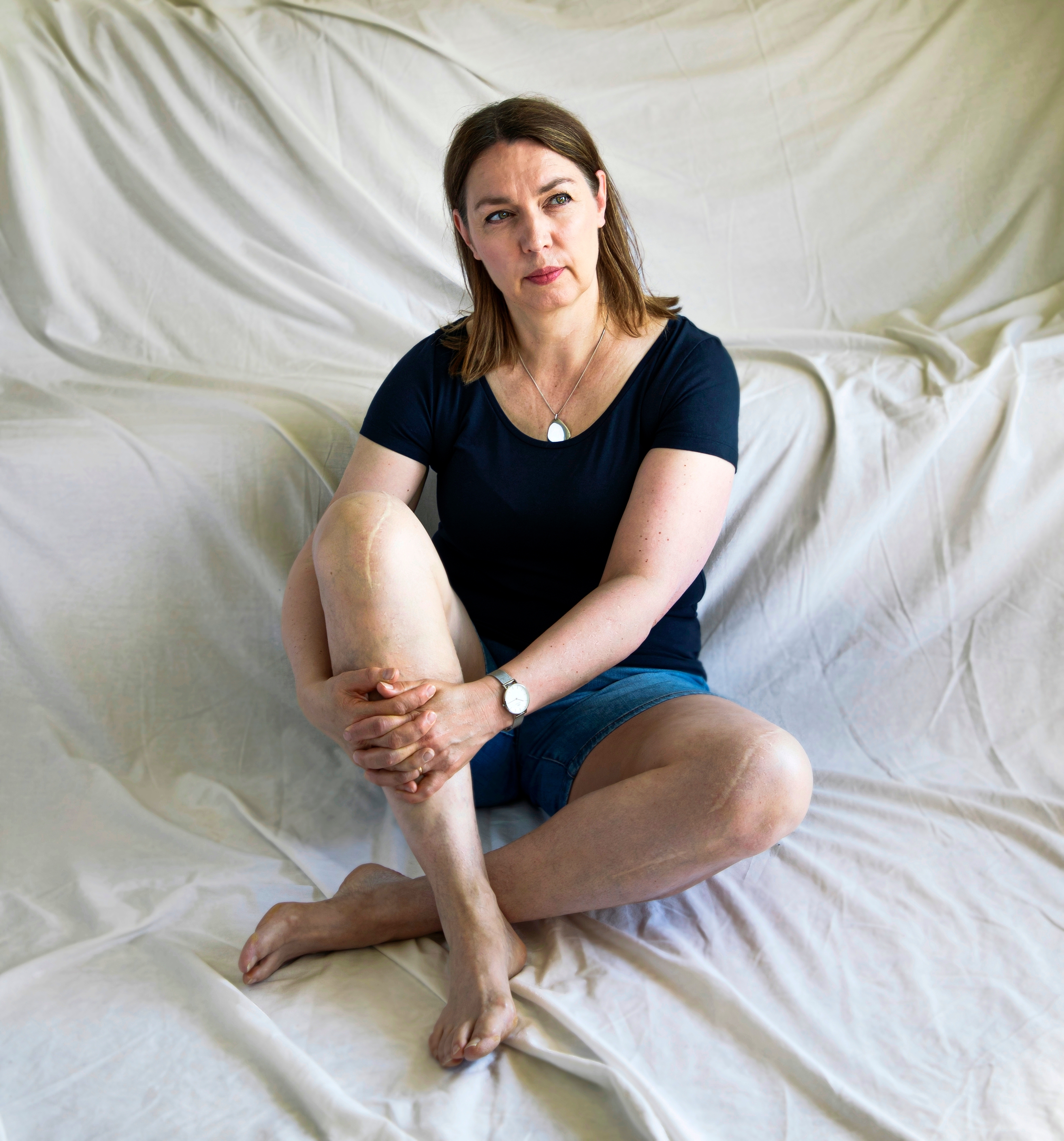 Arpeni tarina | "Naurattaa, että nuorempana häpesin arpiani" | Apu Terveys