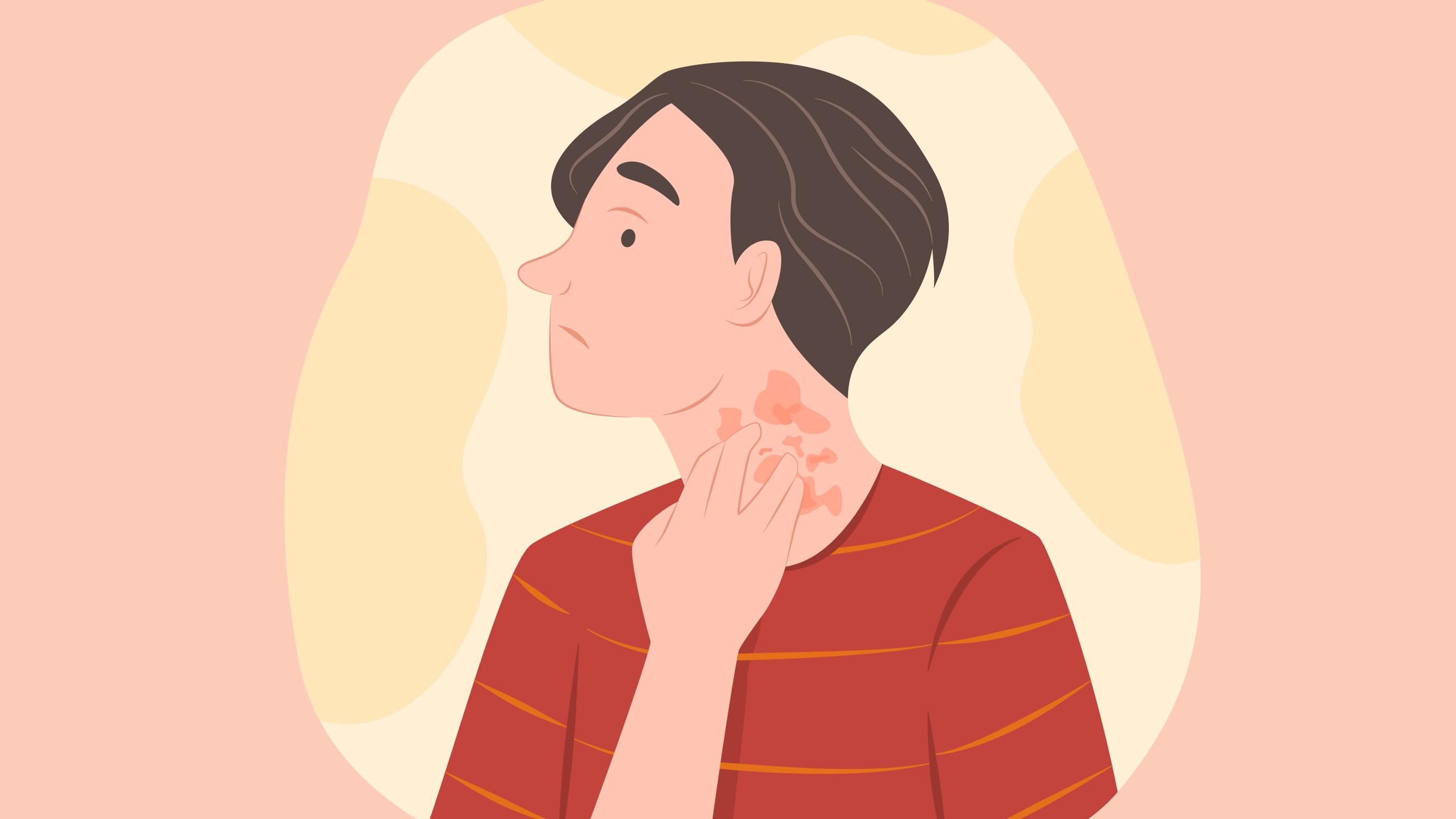 Nokkosihottuma eli urtikaria | Näin hoidat – viisi vinkkiä | Apu