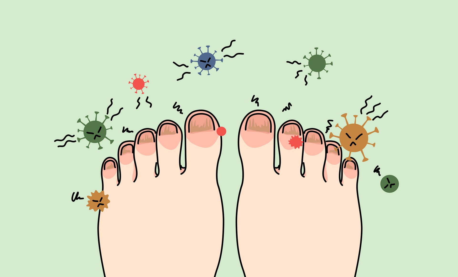 Kynsisienen hoito varpaassa, lakka vai lääkkeet? Kysy terveydestä | Apu