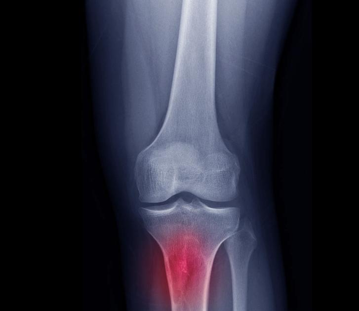 Bakerin kysta polvessa, jumppa pahentaa kipua – Apu-klinikka | Apu